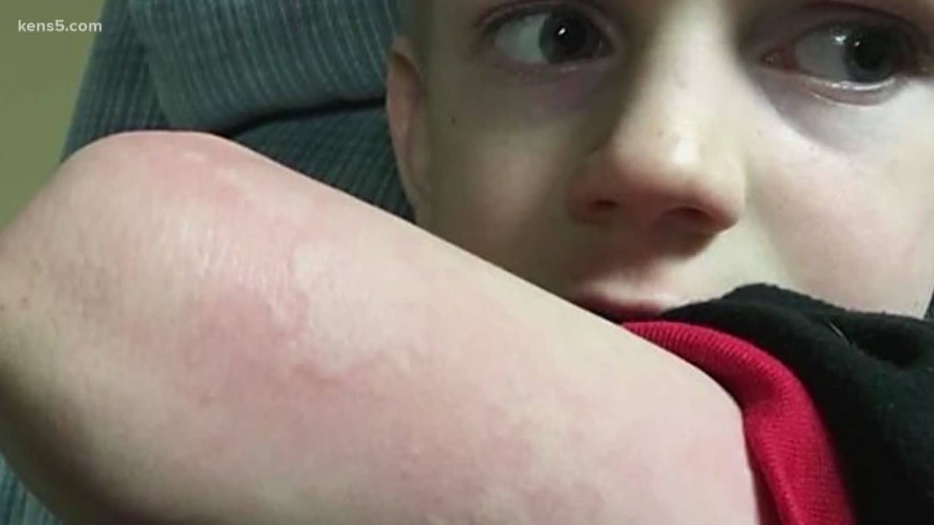 Hives In Children