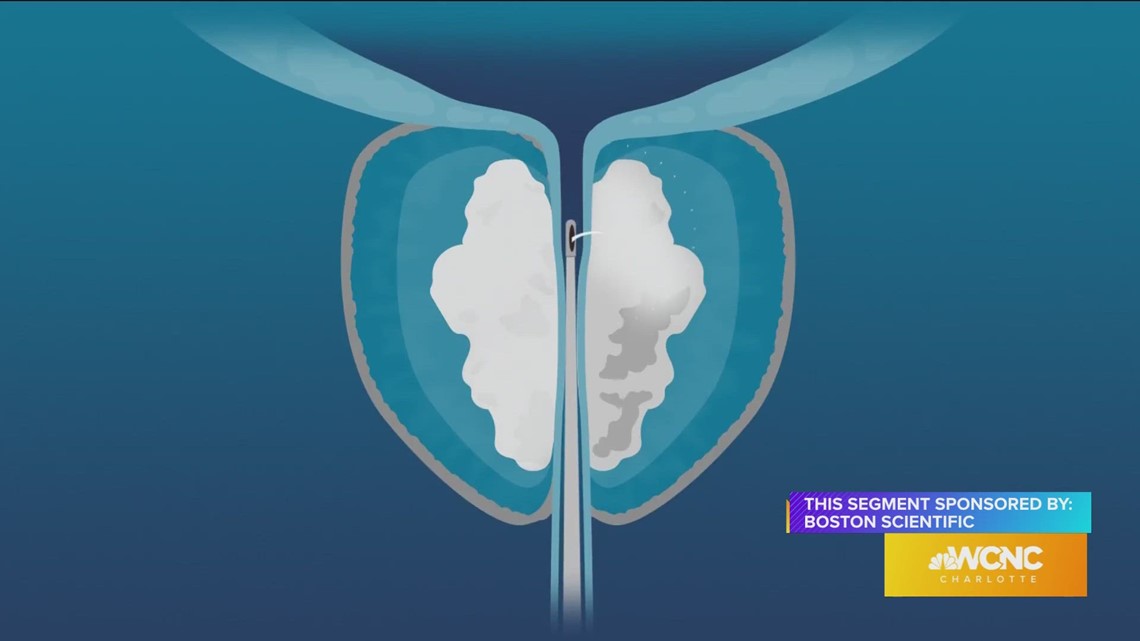 Treating Benign Prostatic Hyperplasia (BPH) - sponsored by Boston ...