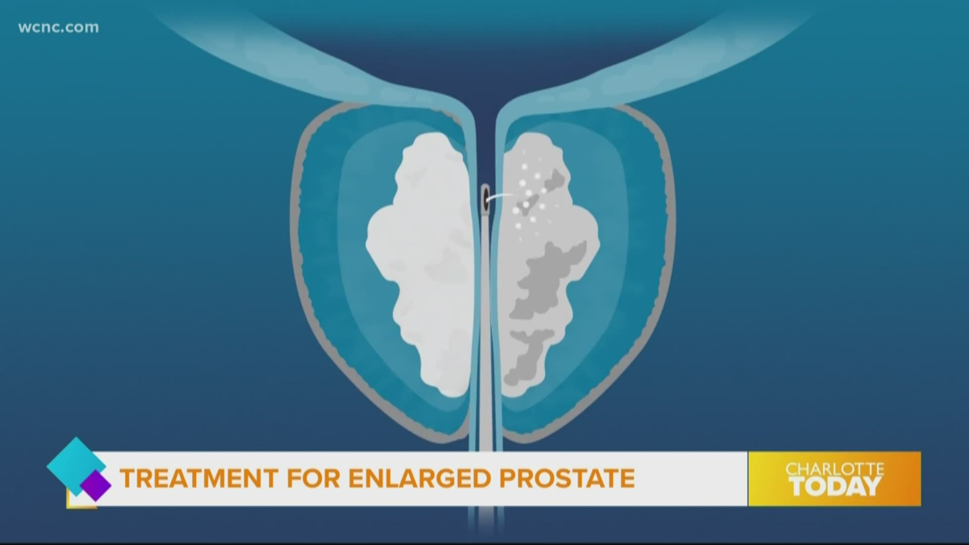 The most common problem for men over 50 | wcnc.com