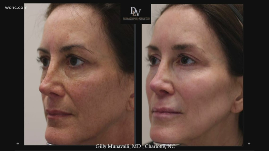 Special savings on Botox and fillers | wcnc.com