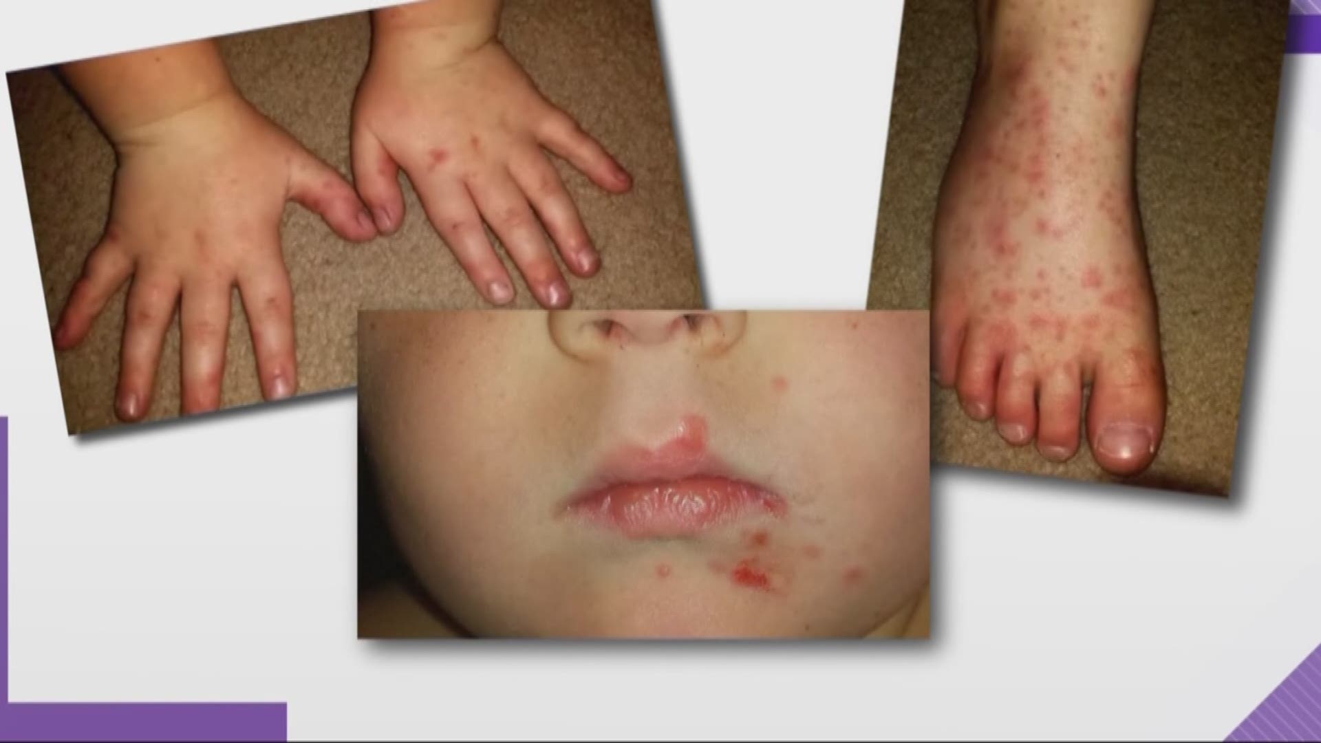 2 dozen cases of hand, foot and mouth disease confirmed in York Co ...