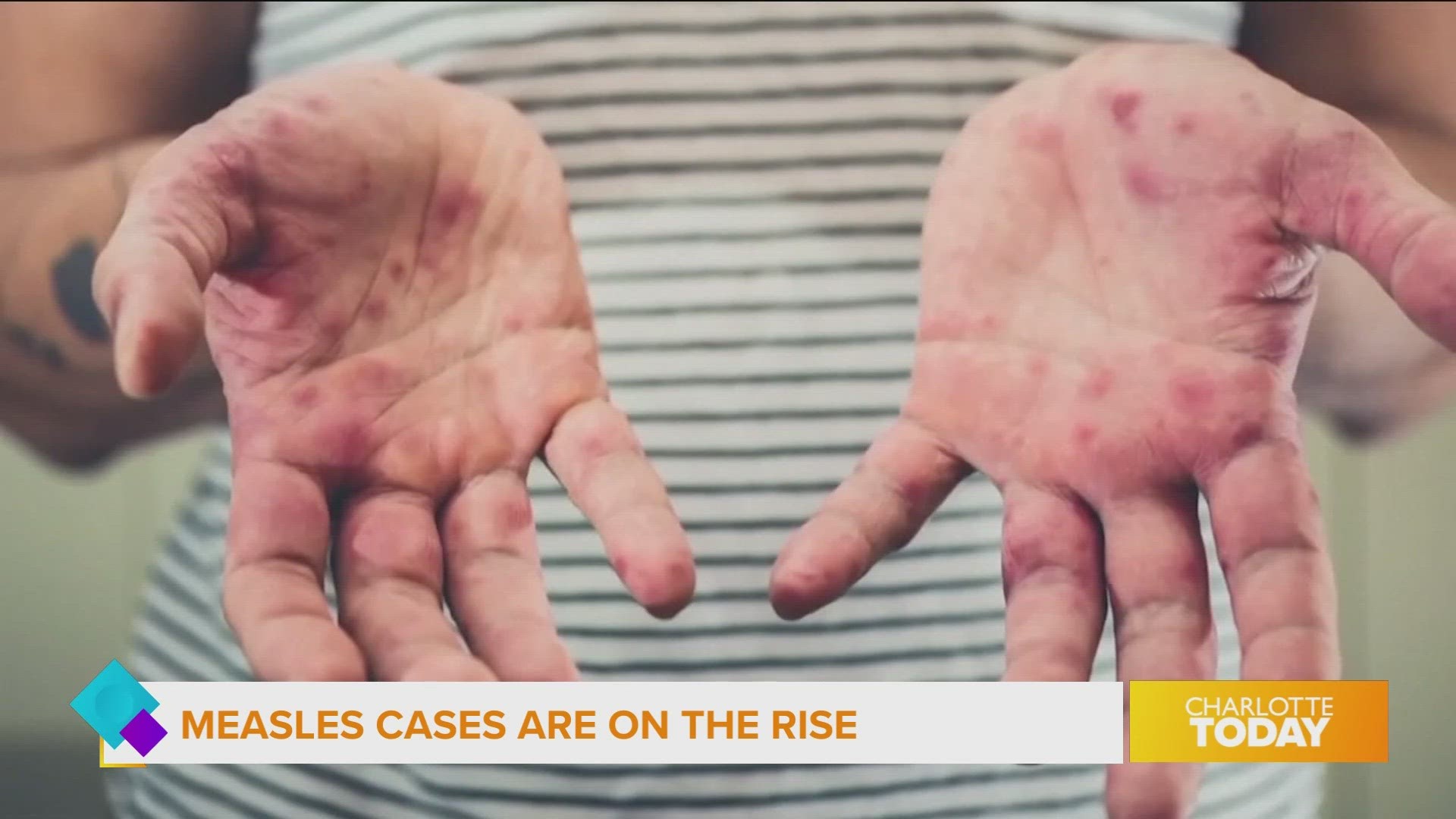 Prevent the spread of Measles, get vaccinated! | wcnc.com