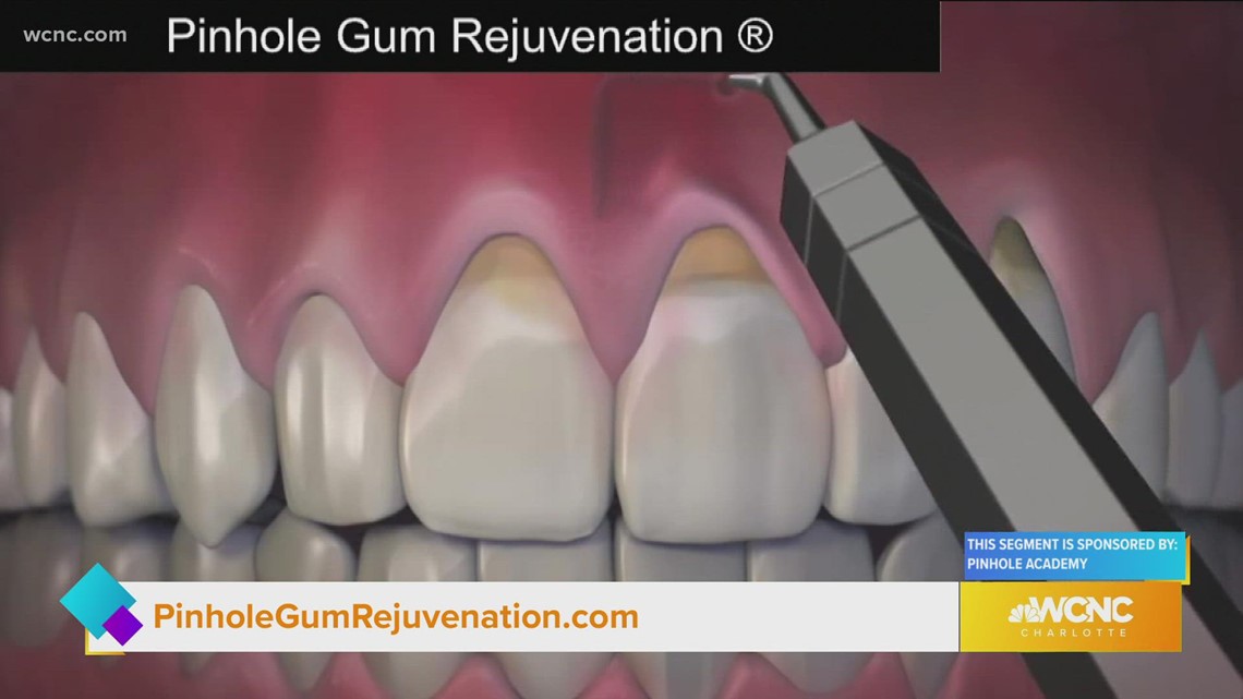 Pinhole Gum Rejuvenation is the first minimally invasive treatment to ...