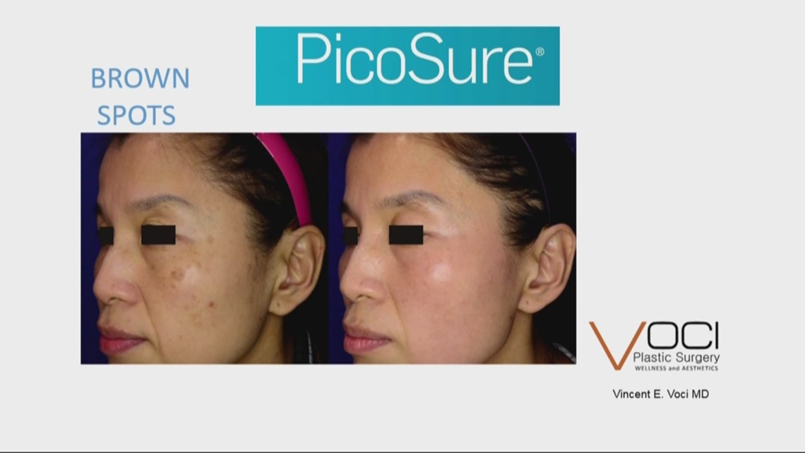 Get rid of brown spots and acne scars on your skin | wcnc.com