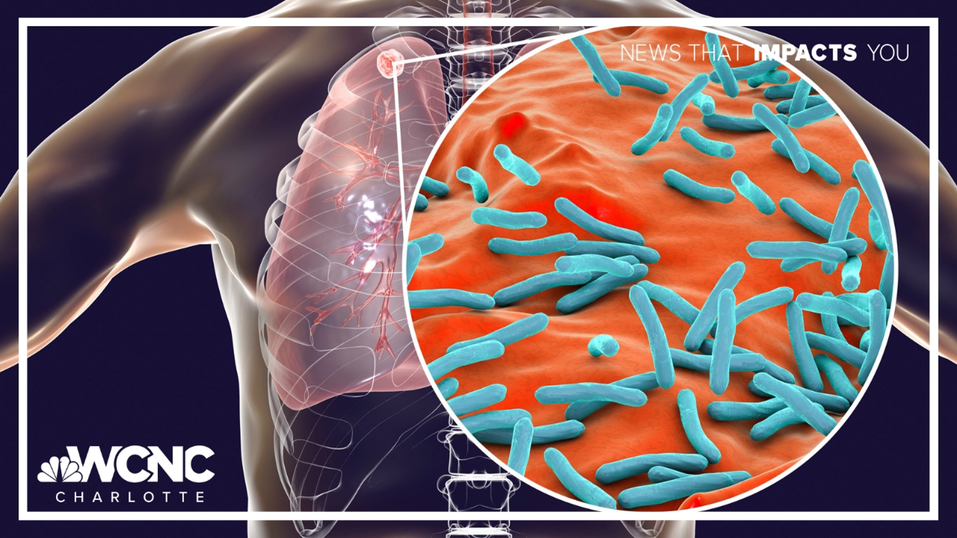 Tuberculosis confirmed, patient in isolation in Avery County, NC | wcnc.com