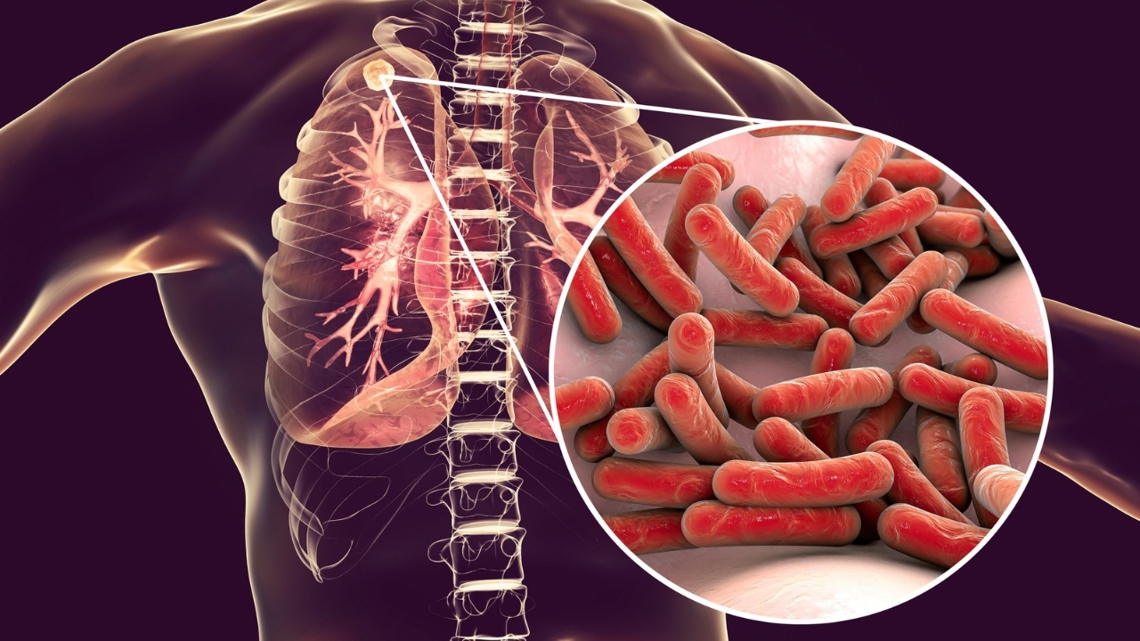 VERIFY: How contagious is Tuberculosis? | wcnc.com