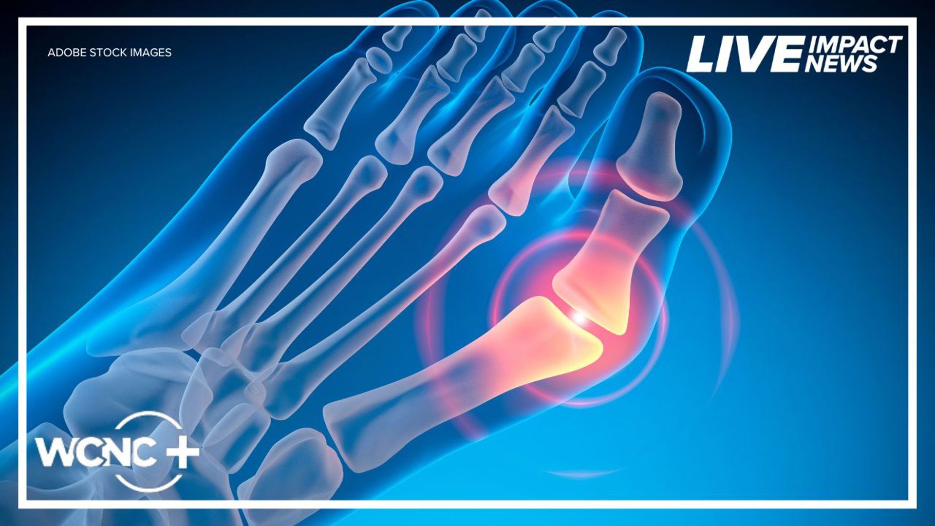 Breakthrough AI technology creates an improvement for bunion surgery ...