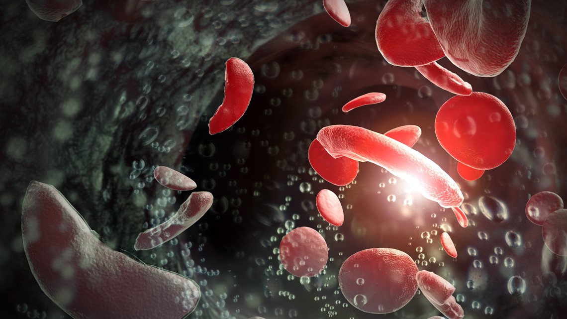 Expanding access to new sickle cell disease treatment in NC | wcnc.com