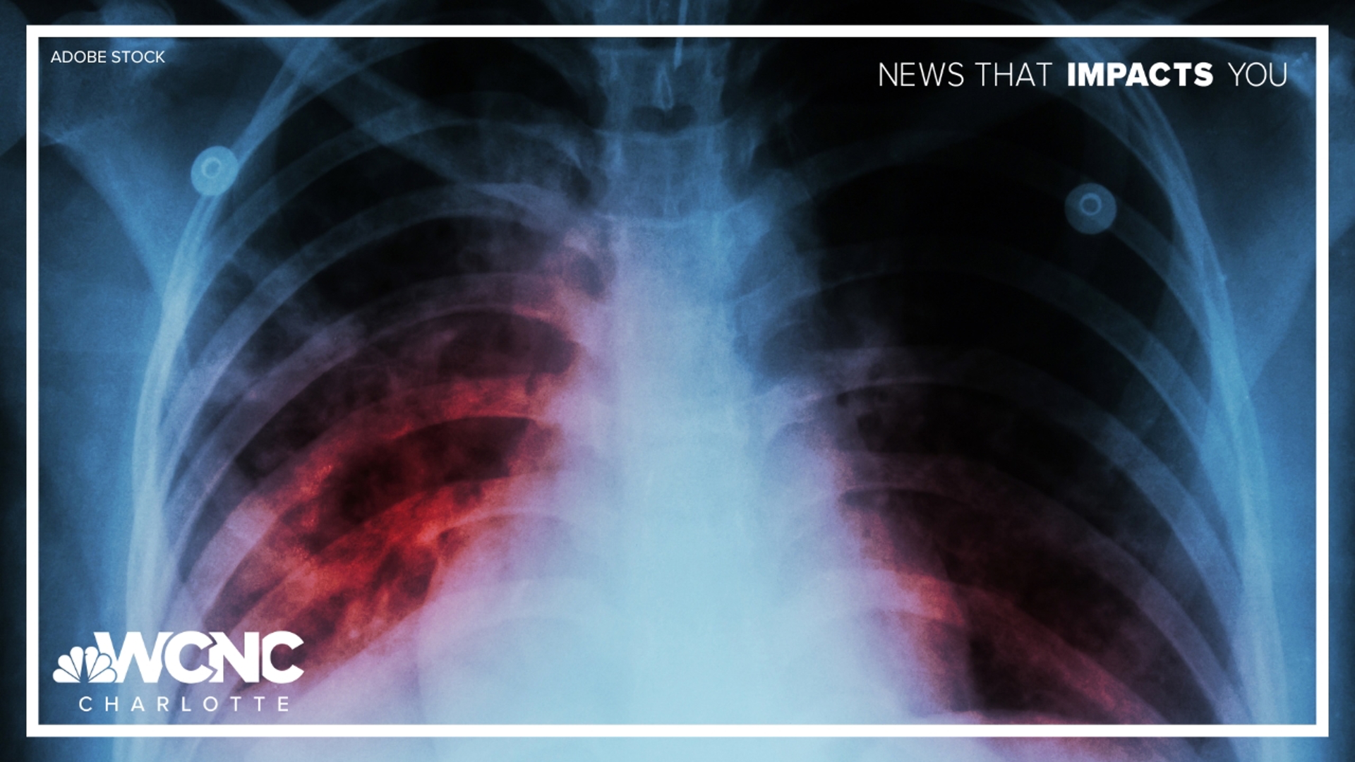 North Carolina tuberculosis cases on the rise after 30 years of decline ...