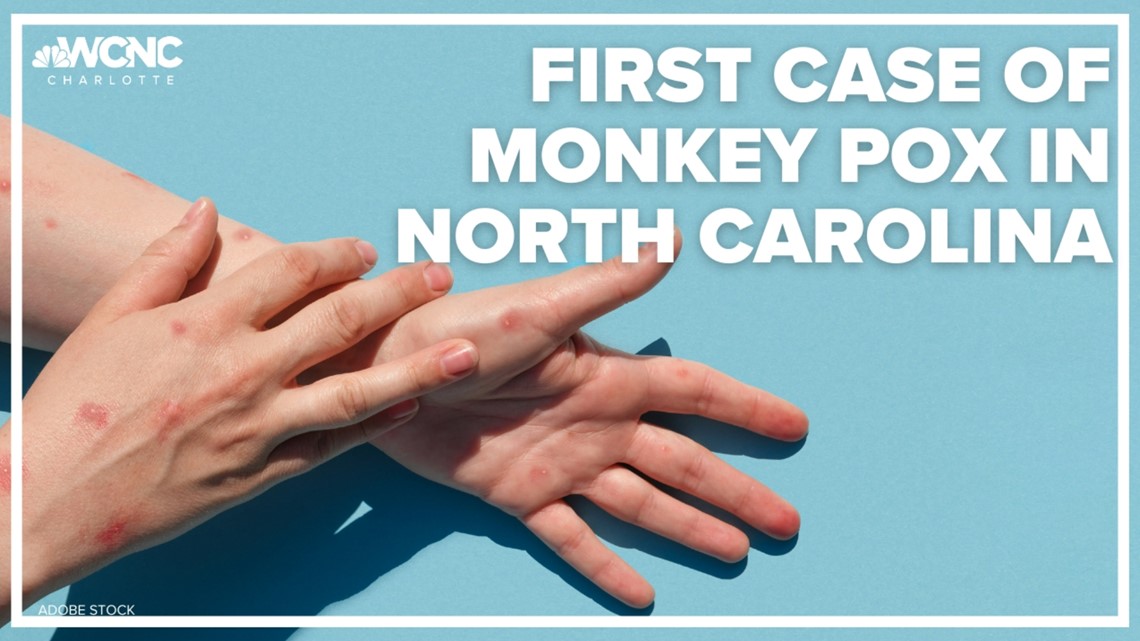 Officials identify first case of Monkeypox in North Carolina | wcnc.com