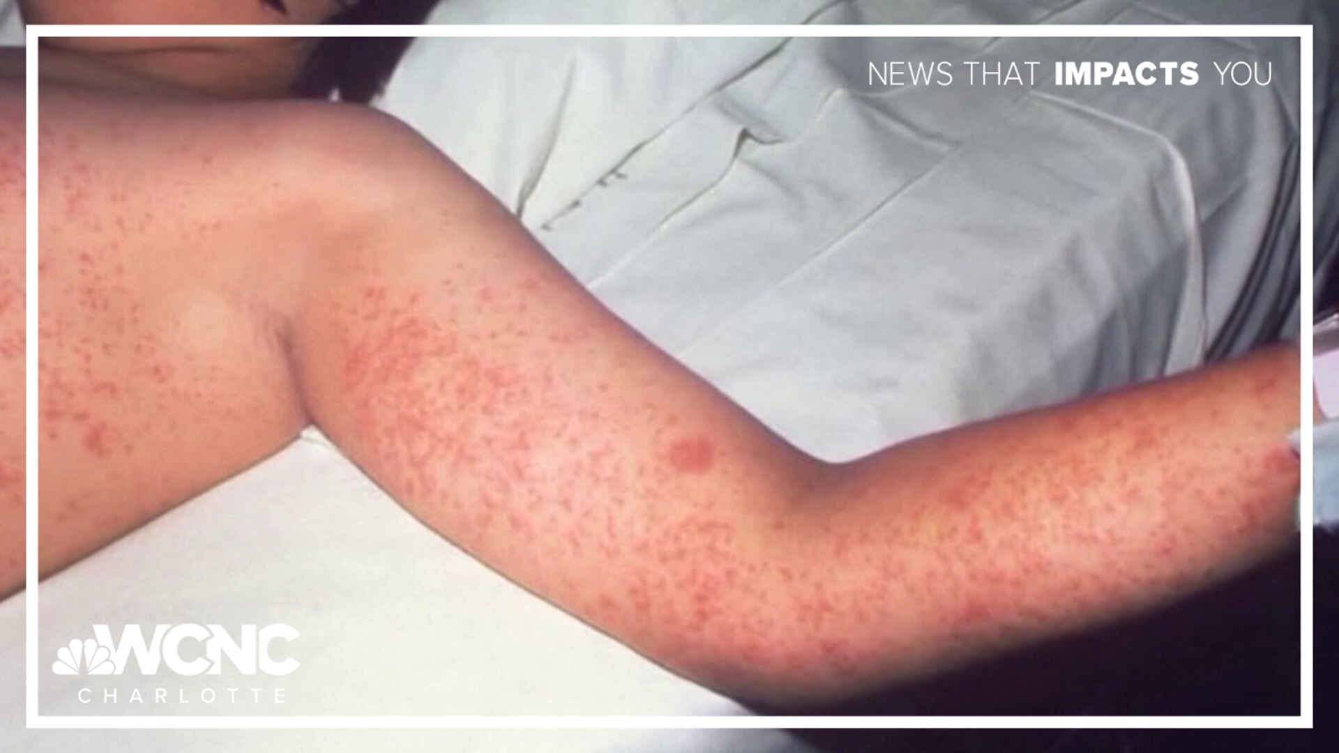 SC Dept. of Public Health confirms case of measles in Upstate patient ...