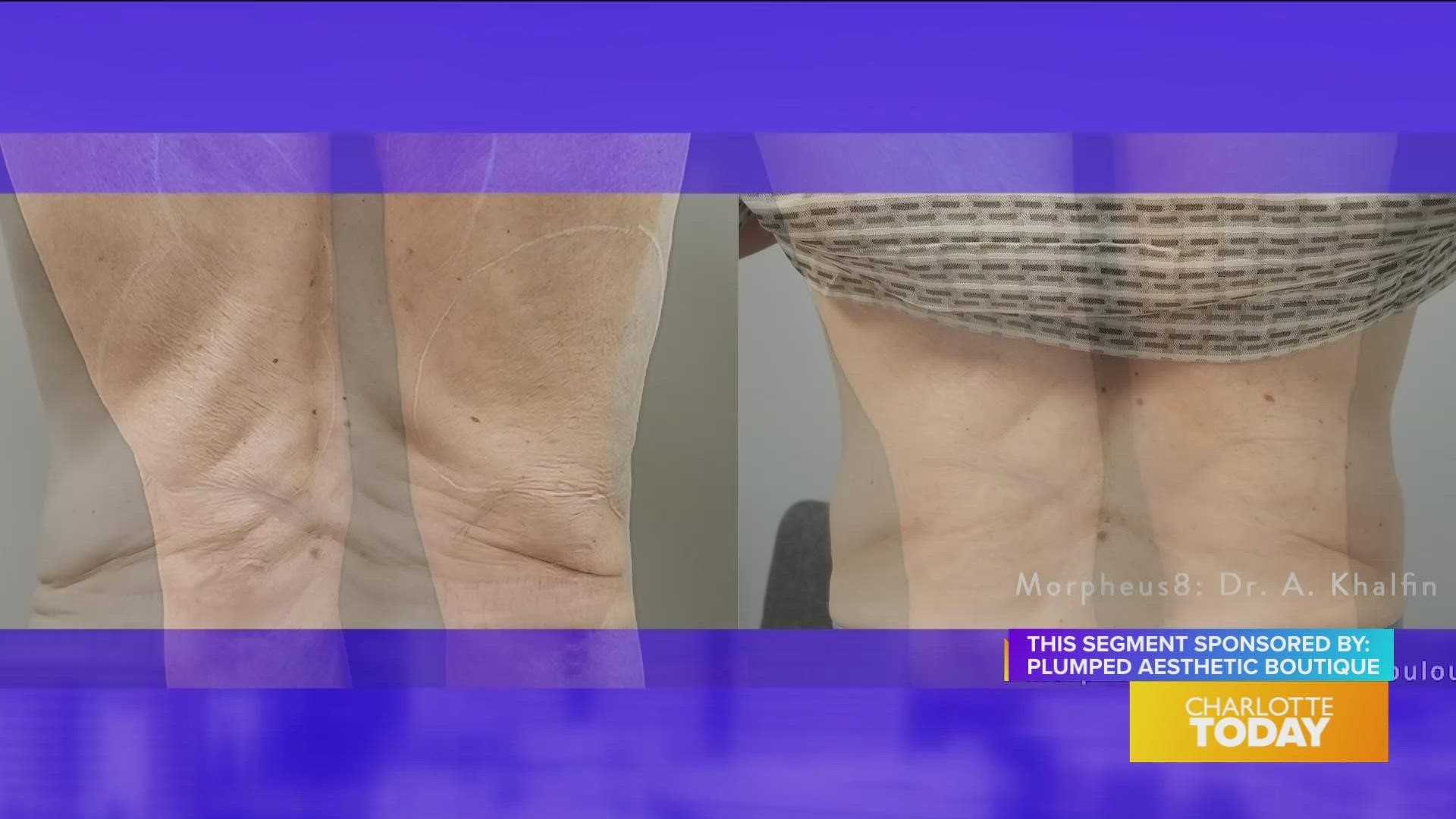 Morpheus 8 Microneedling Goes Full-Body | wcnc.com