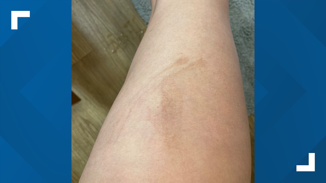 Margarita Burn is a real condition | wcnc.com
